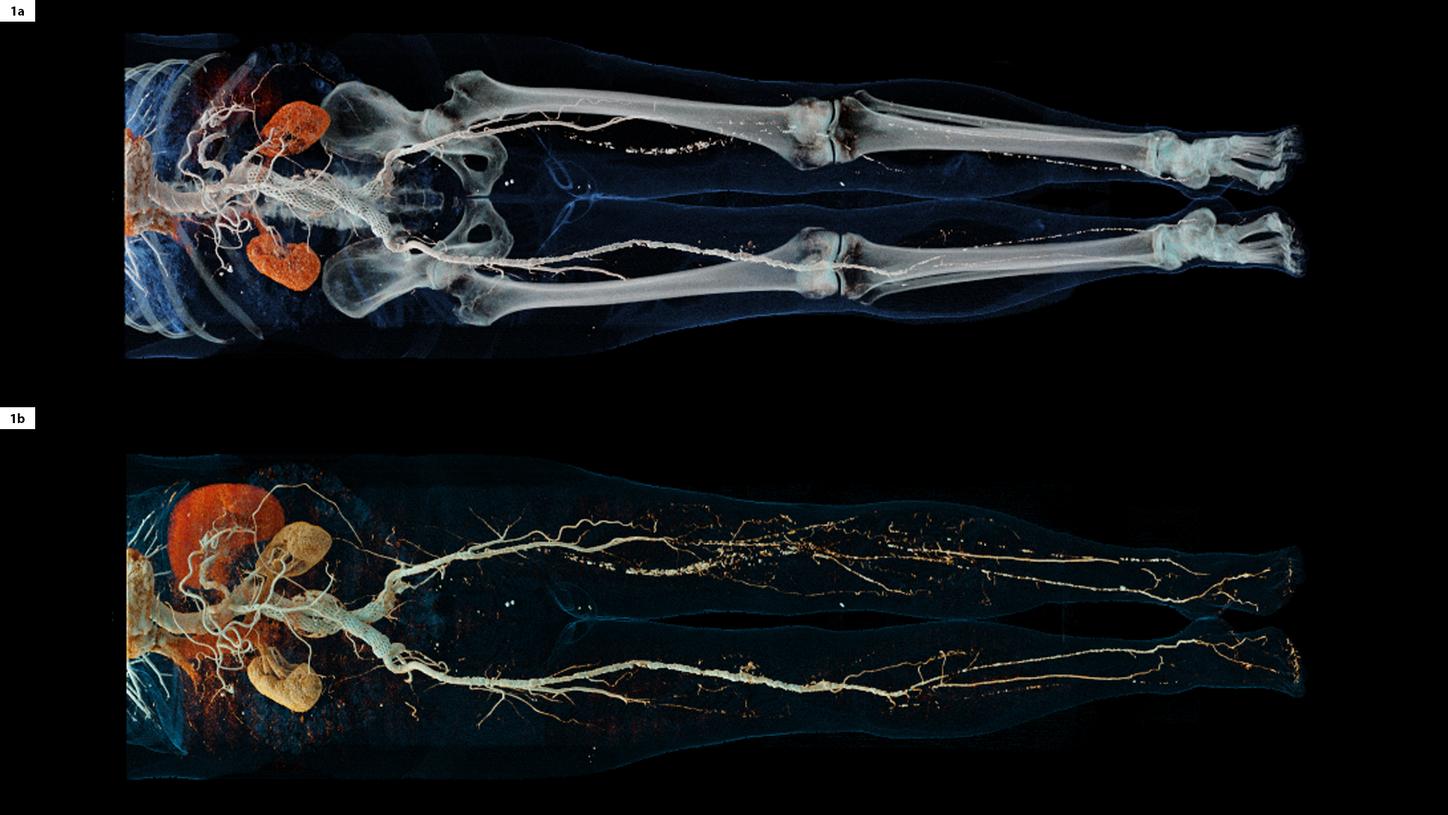 Abdominal Aortic Stent Grafts Combined with Peripheral Vascular Disease