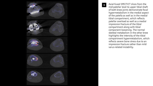 Loosening of tibial component of knee arthroplasty with medial ...