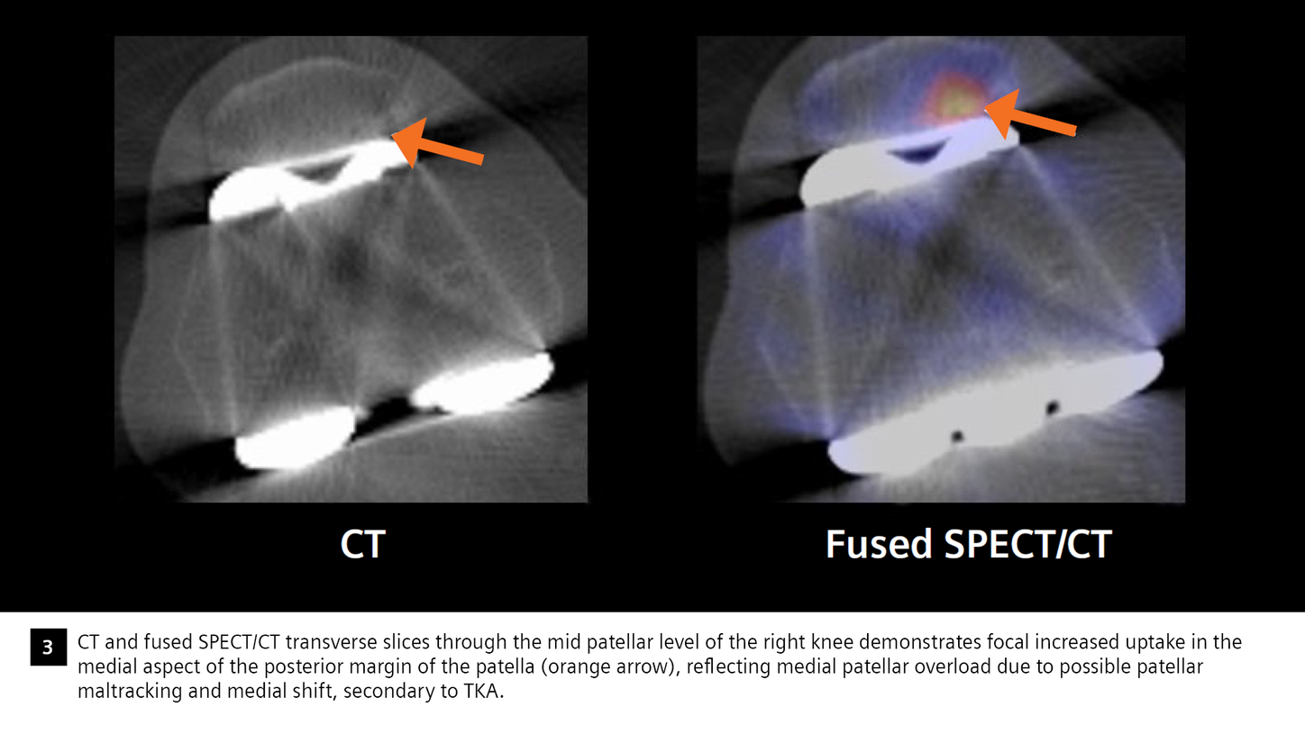 Loosening of tibial component of knee arthroplasty with medial ...