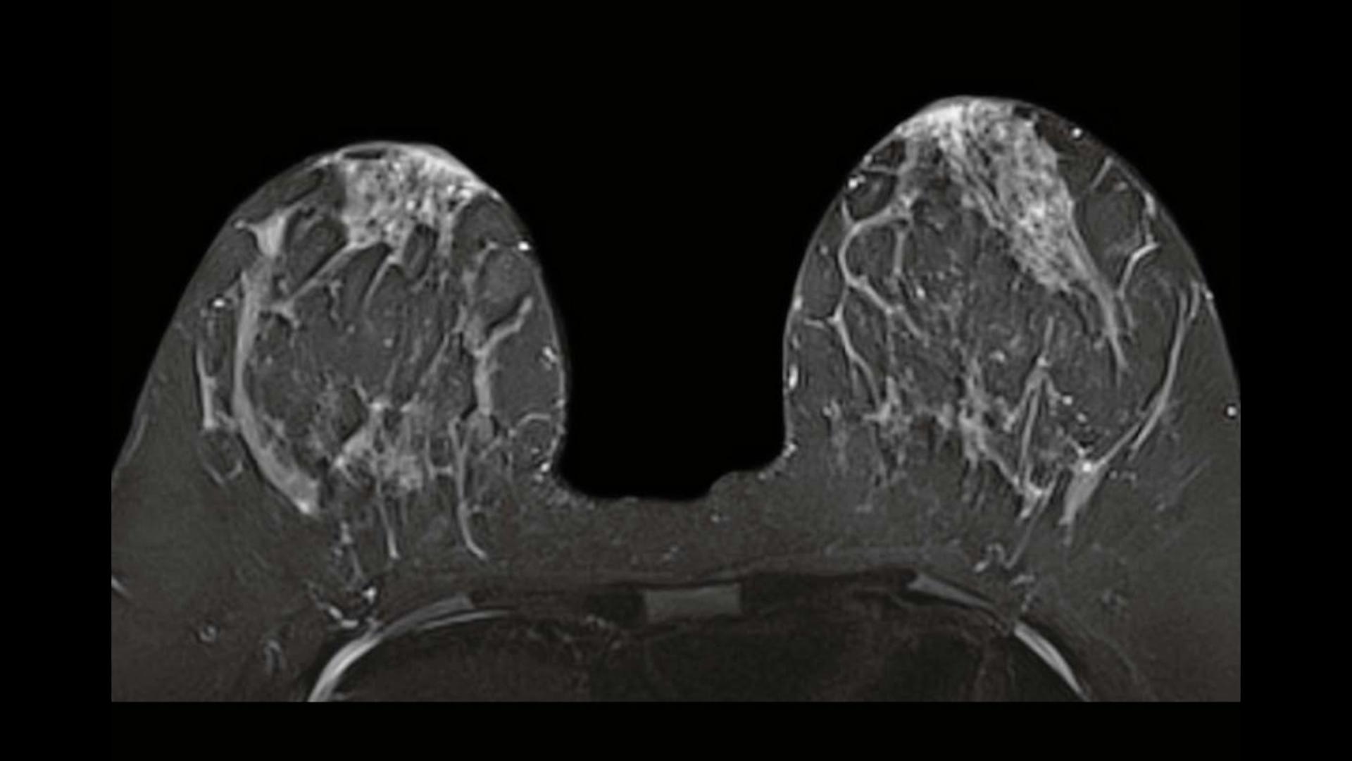 Breast MRI