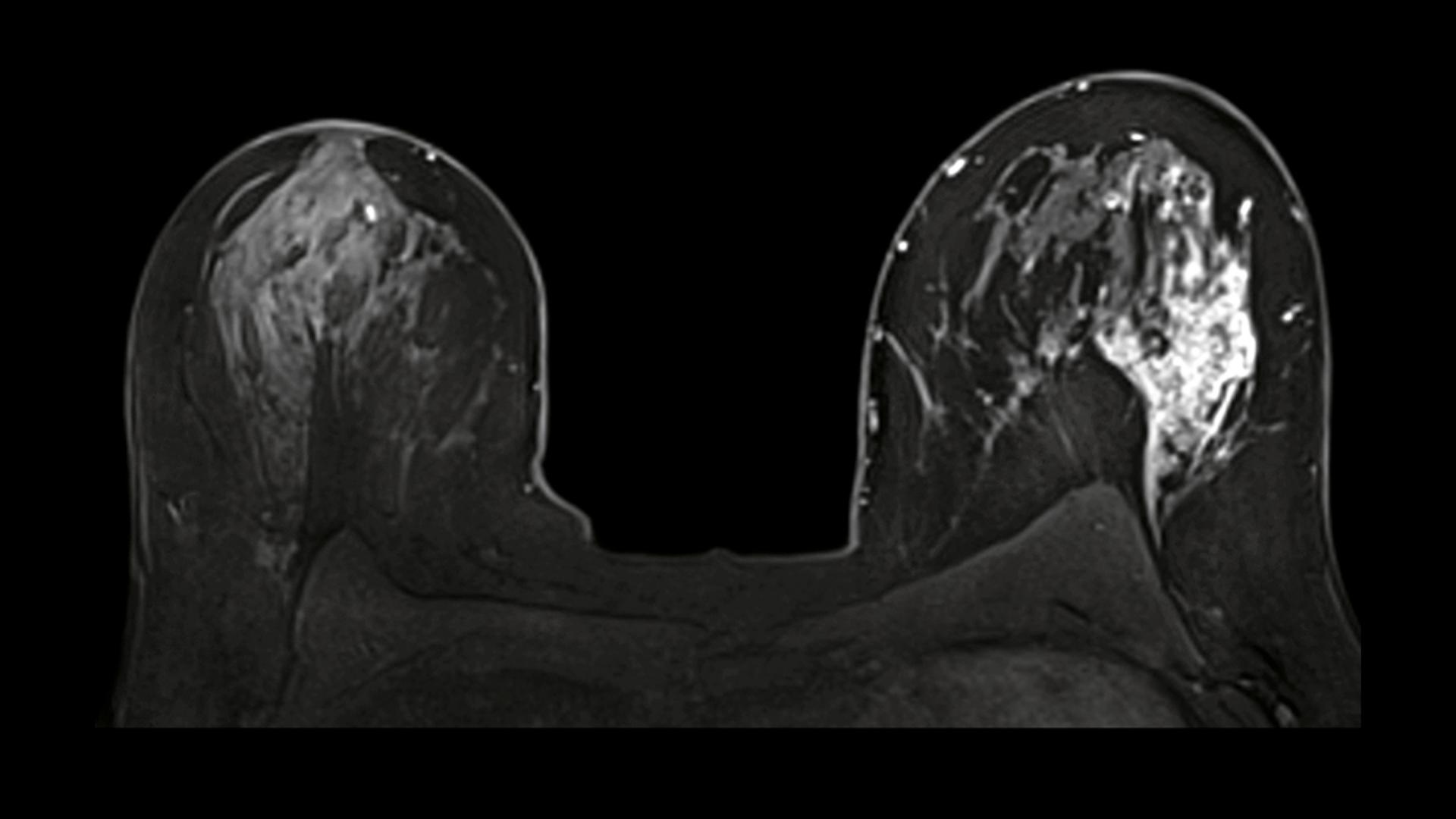 Breast MRI
