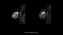 Breast MRI