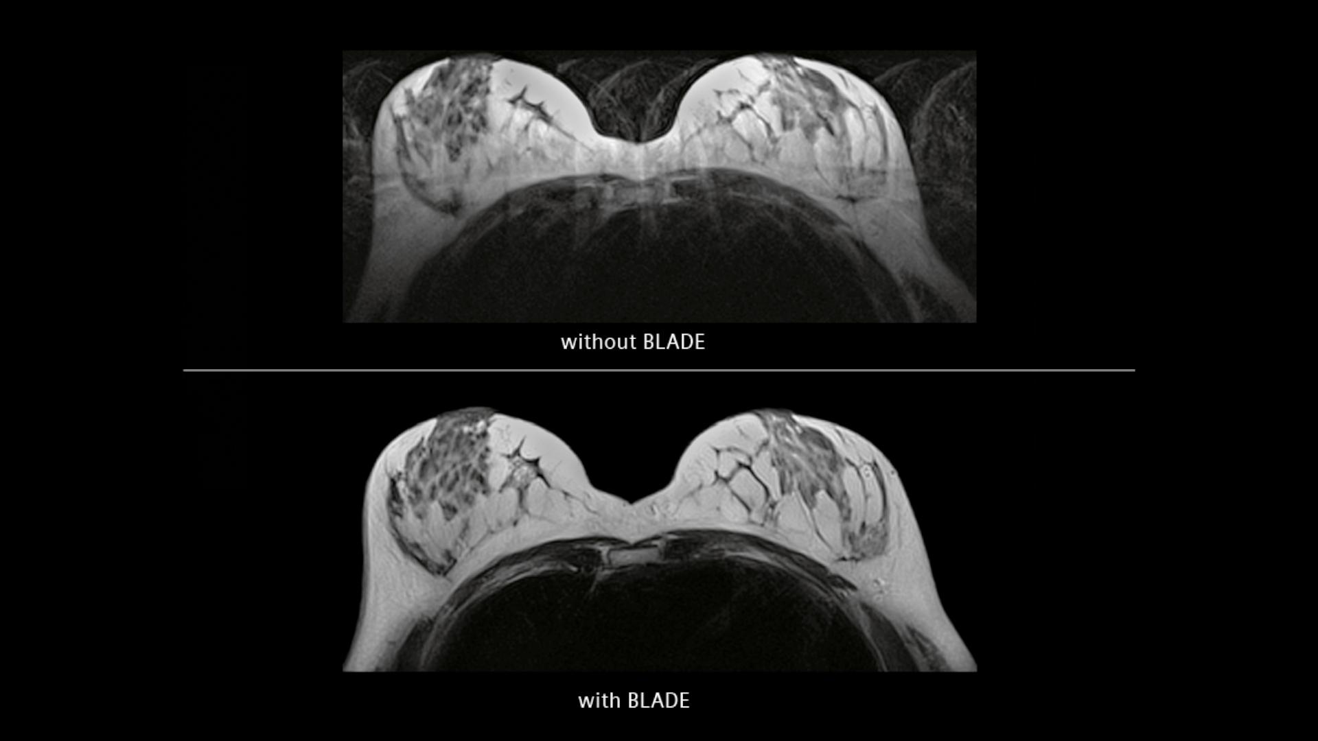 Breast MRI