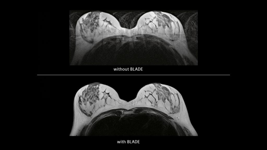 Breast MRI
