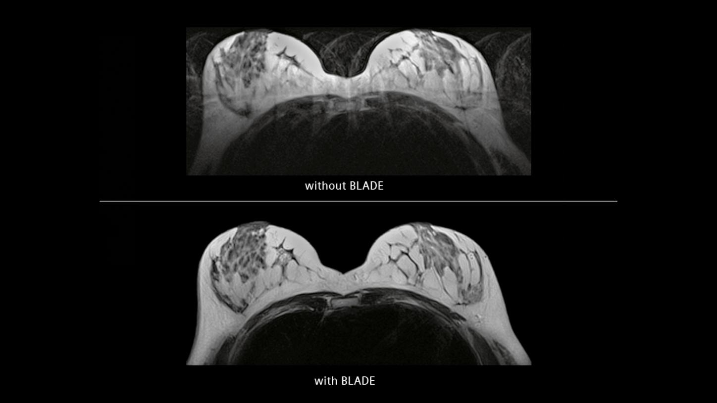 Breast MRI