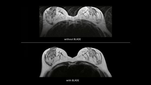 Breast MRI