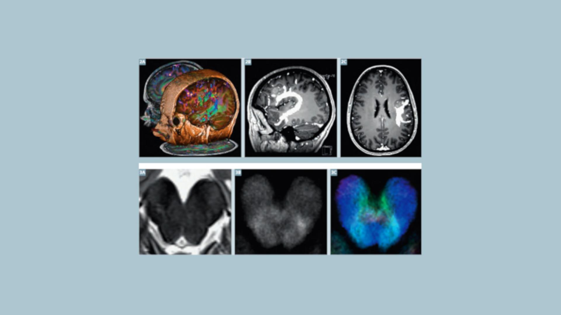 MR Neuro Imaging - MRI Neurology