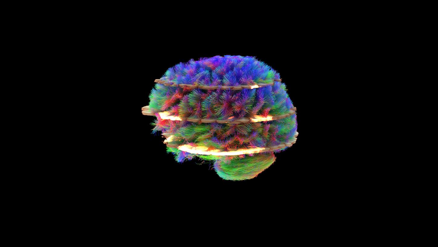 MR Neuro Imaging - MRI Neurology