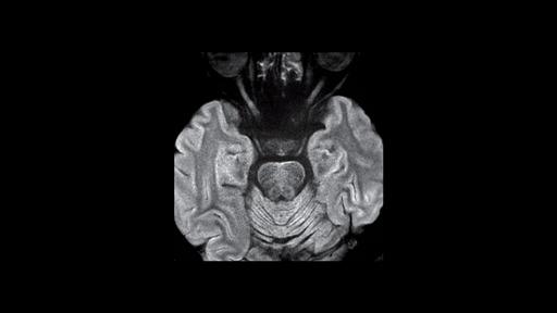 MR Neuro Imaging - MRI Neurology