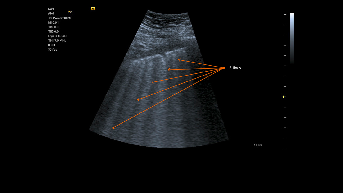 White Paper: Lung Ultrasound in Patients with Coronavirus COVID-19 Disease