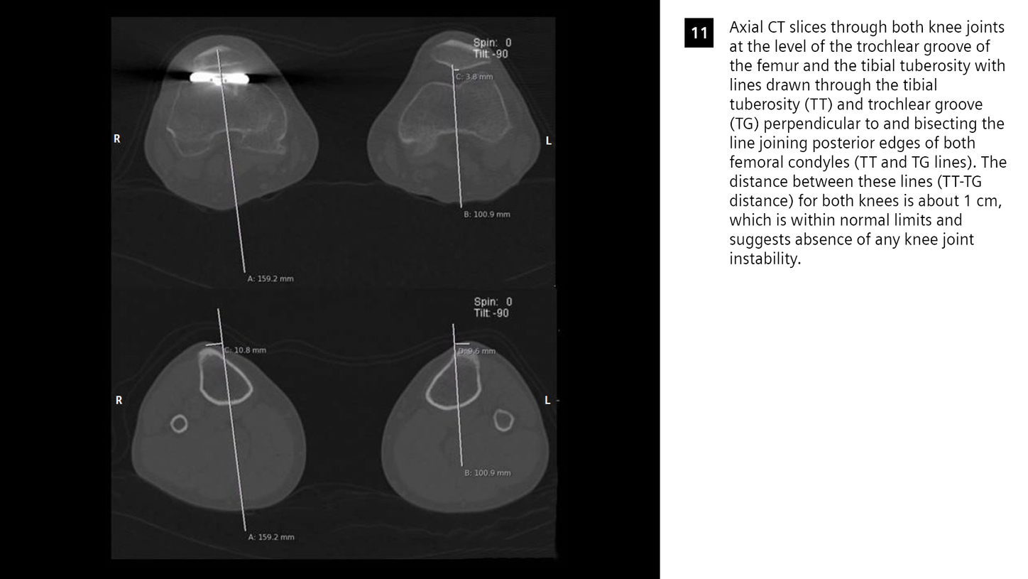 SPECT/CT in evaluation of anterior knee pain following patellofemoral ...