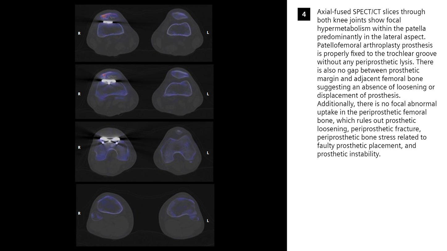 SPECT/CT in evaluation of anterior knee pain following patellofemoral ...