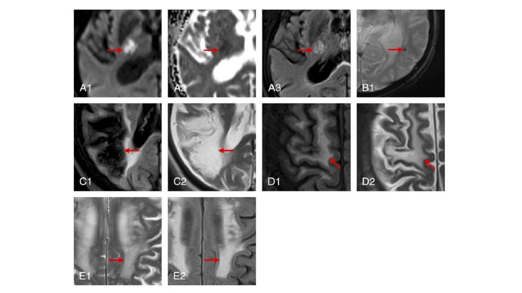 MR Neuro Imaging - MRI Neurology