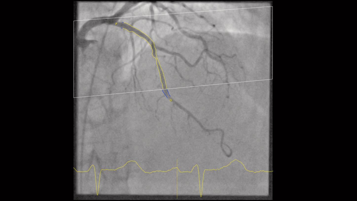 Rethink FFR assessment for every patient