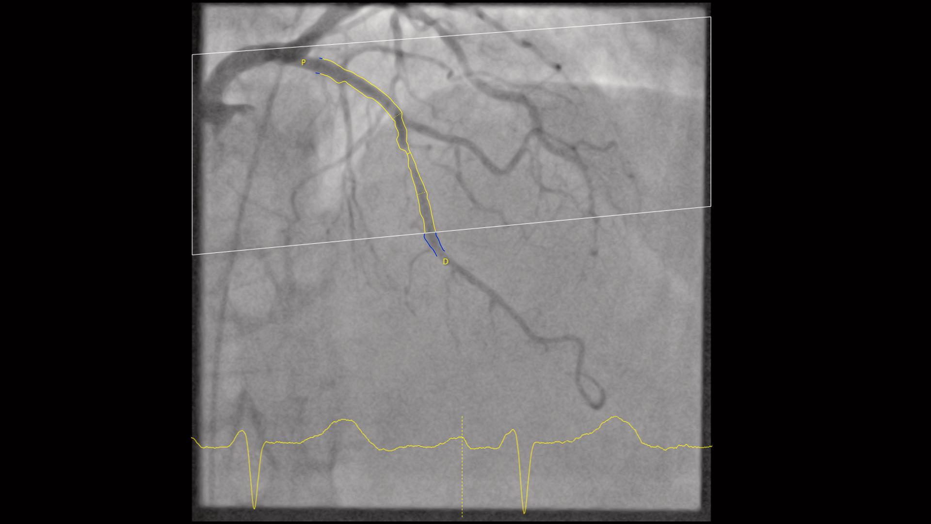 Rethink FFR assessment for every patient