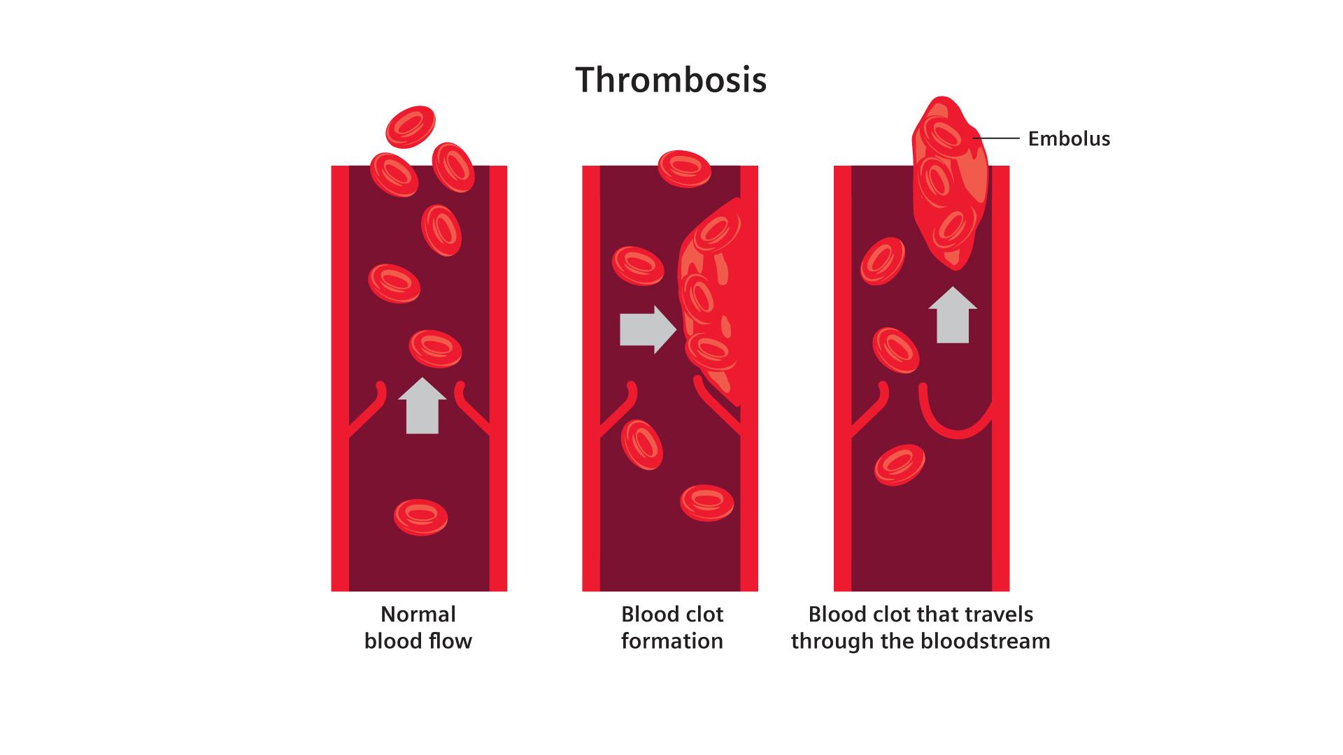 ¿Qué es la hemostasia?
