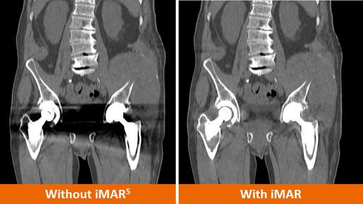 SOMATOM go. platform for Radiation Therapy