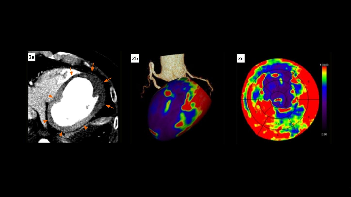 LAD occlusion – acute or chronic?