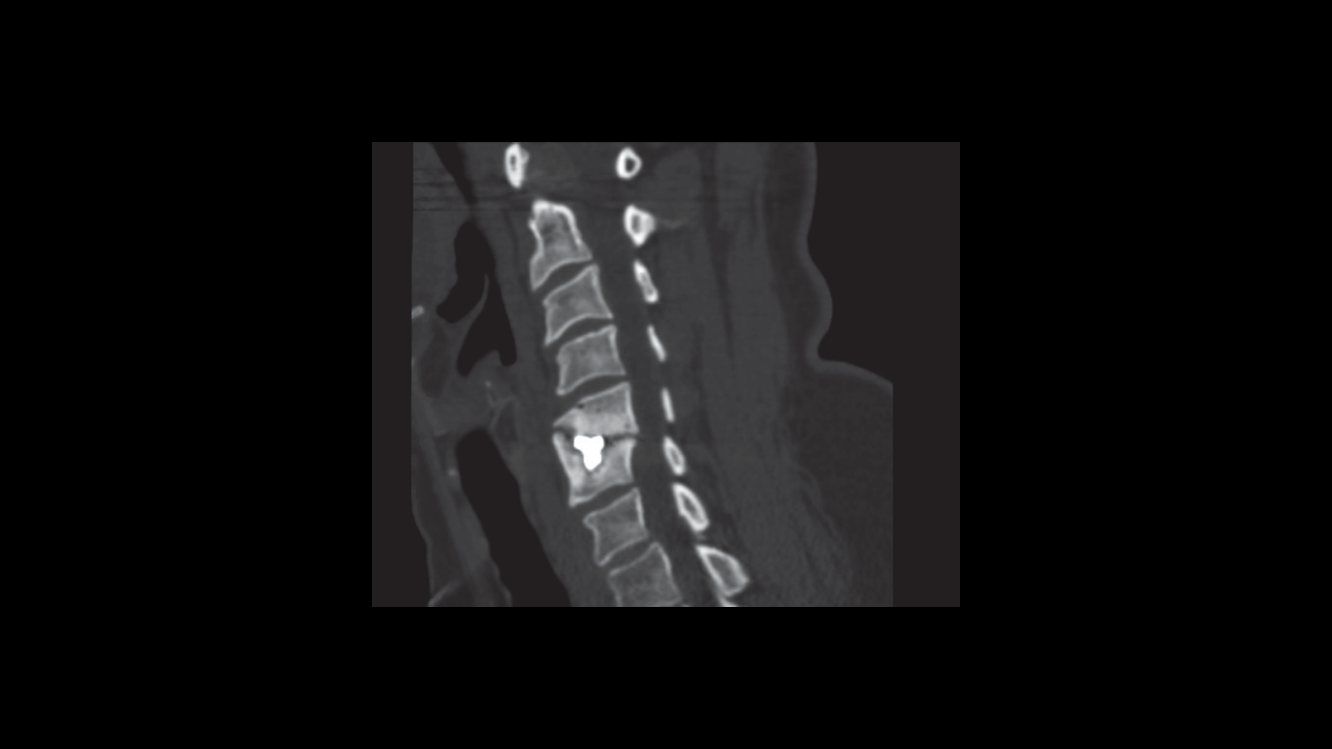 The use of SPECT/CT in a musculoskeletal Physical Medicine and ...