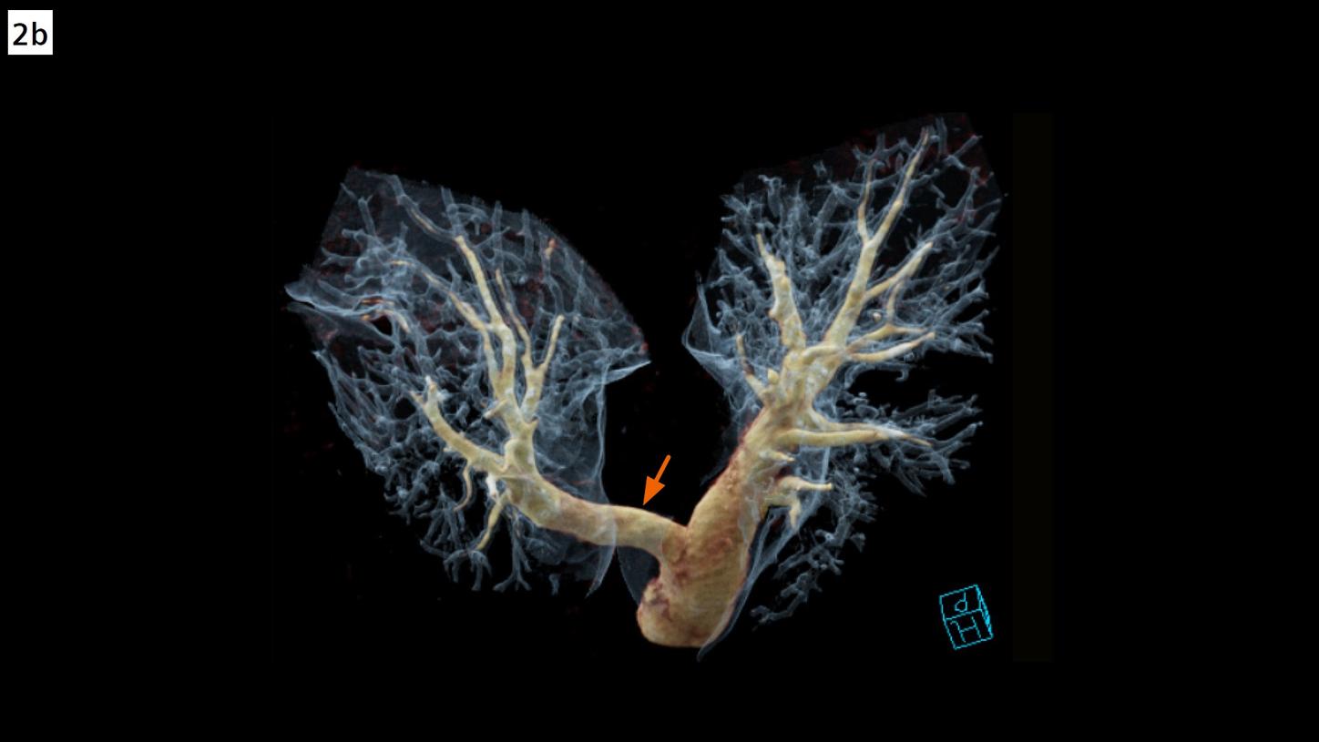 Scimitar syndrome