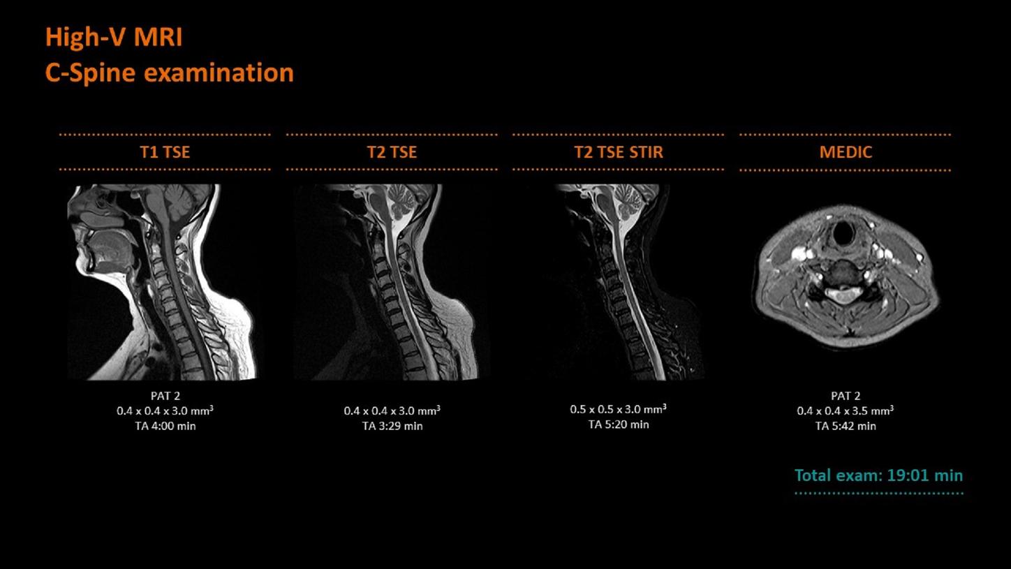 MAGNETOM Free.Max–wide bore mri