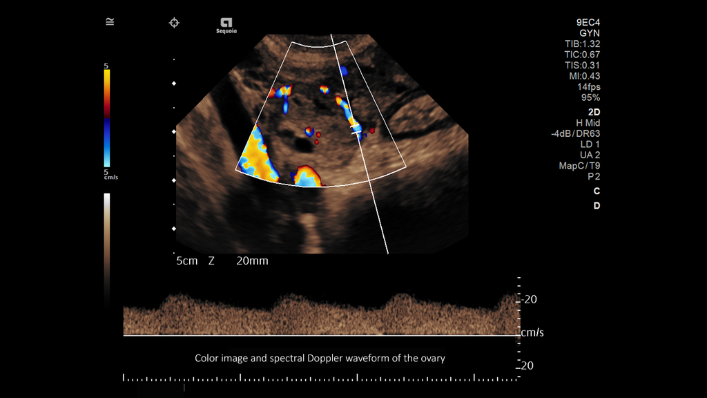 ACUSON Sequoia Ultrasound System