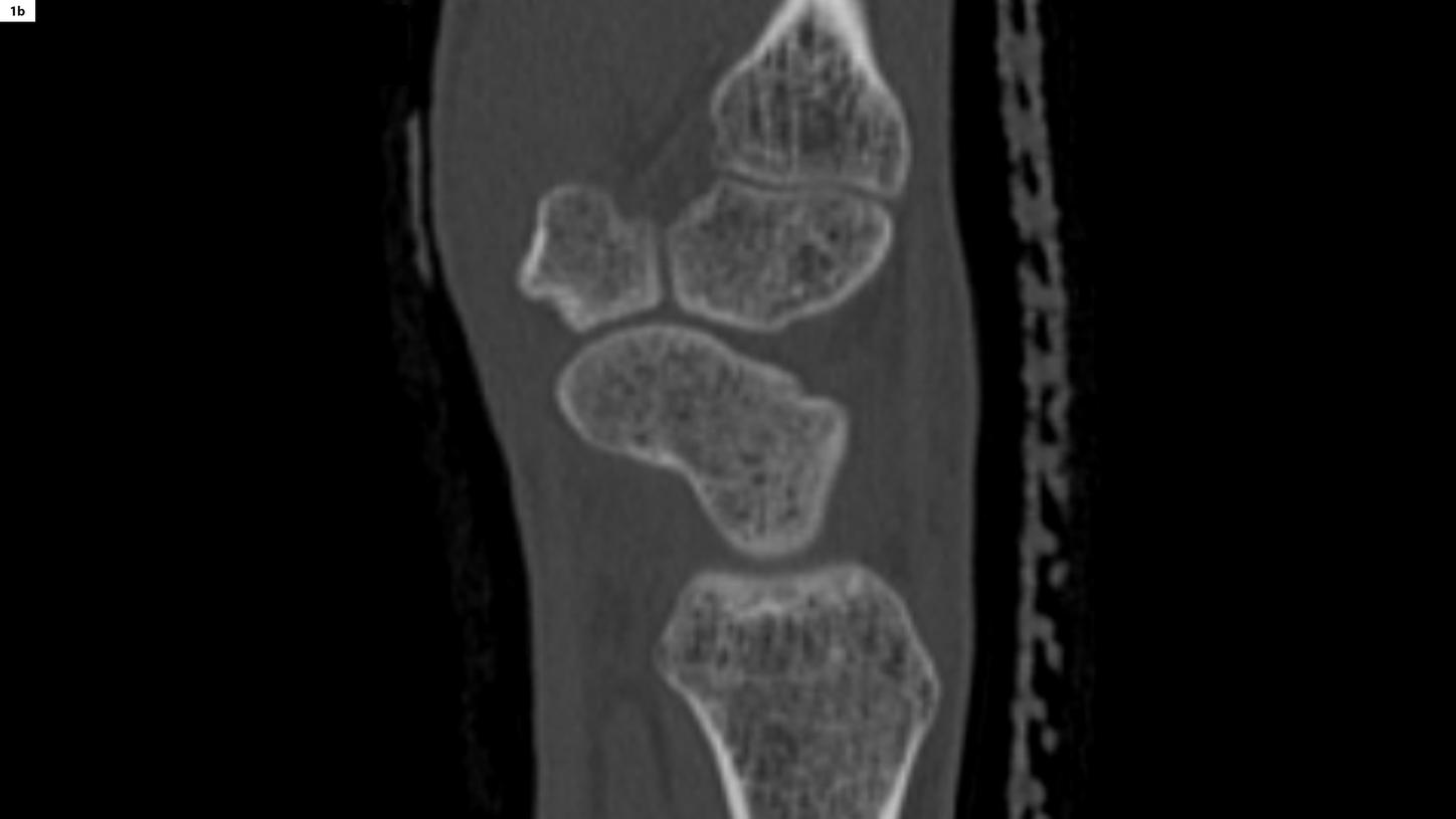 Scaphoid fracture associated bone marrow edema