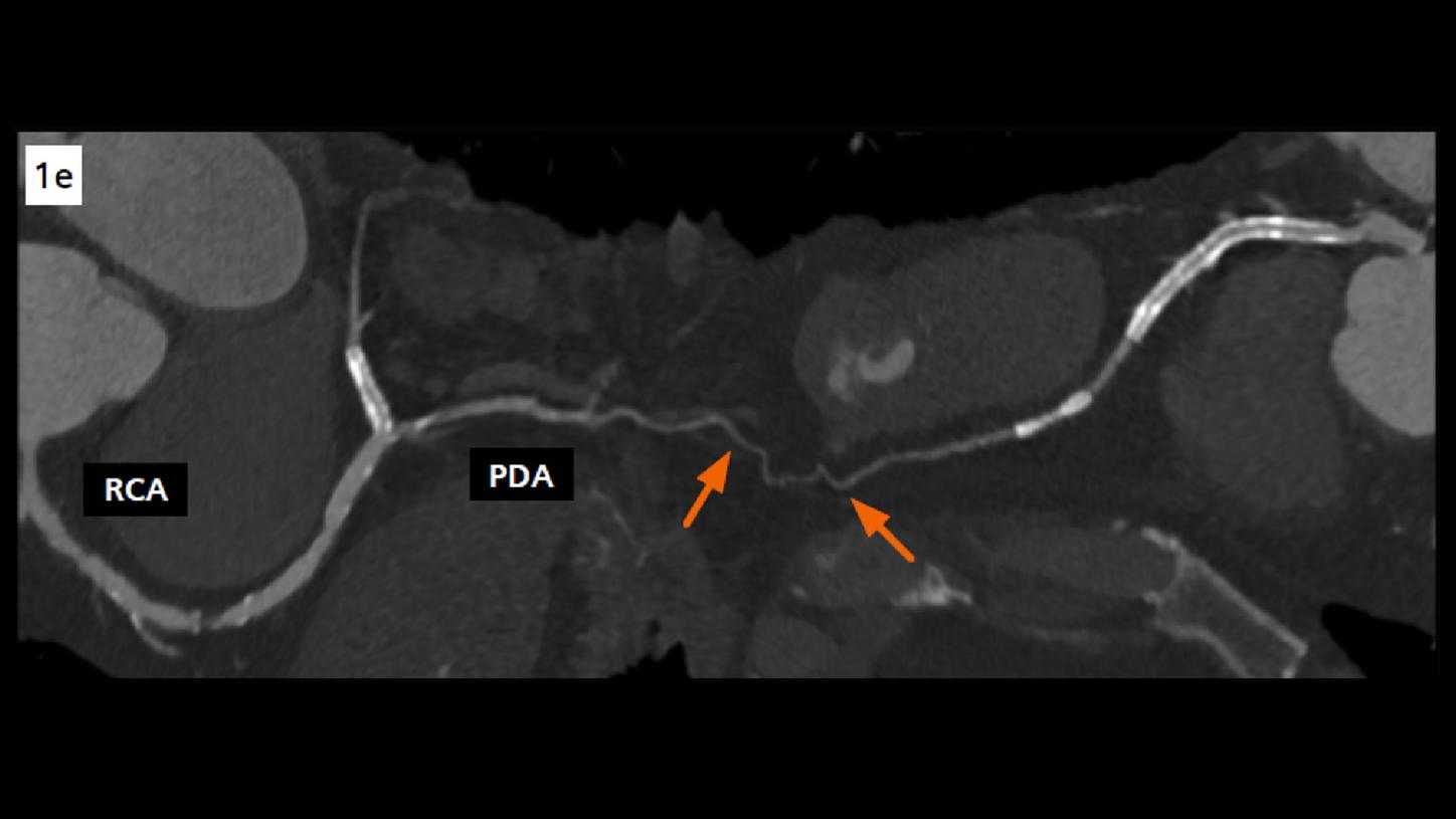 Triple-vessel coronary disease with multiple stents