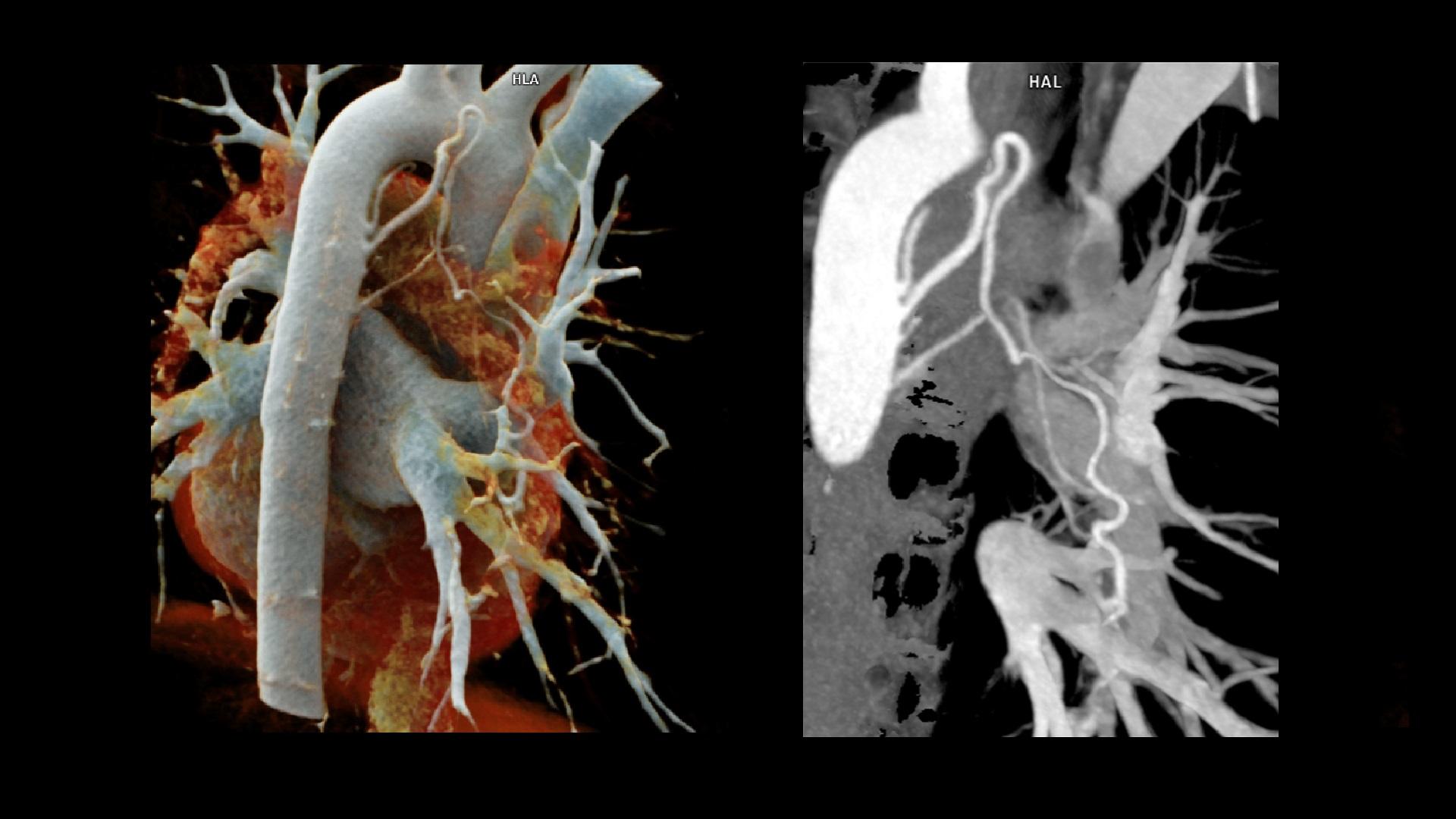 Subcutaneous arteriovenous malformation on the right wrist