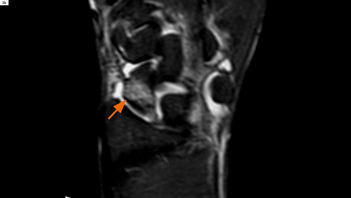 Scaphoid fracture associated bone marrow edema