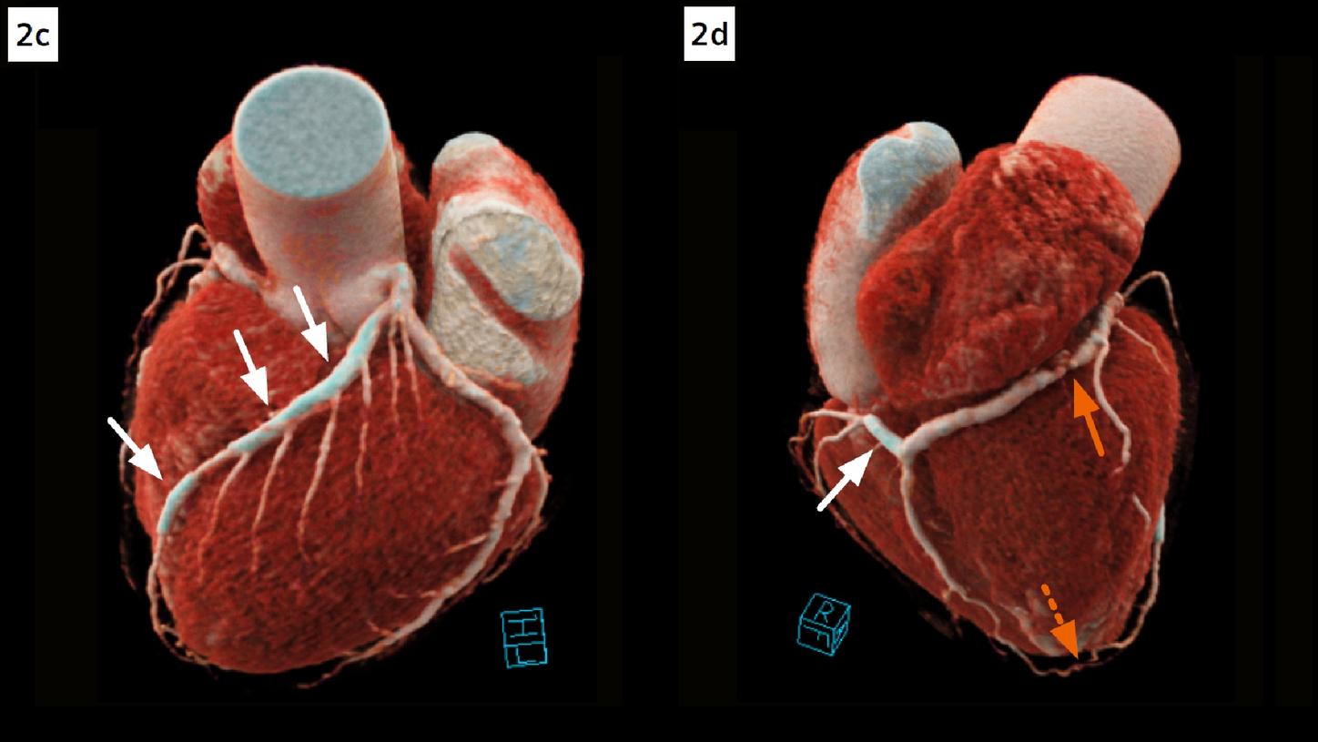 Triple-vessel coronary disease with multiple stents