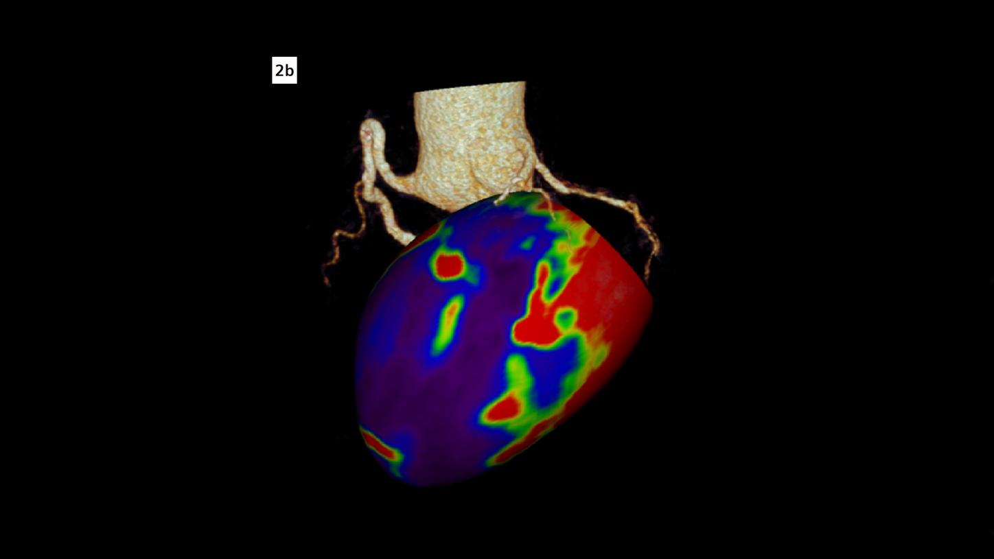 LAD occlusion – acute or chronic?