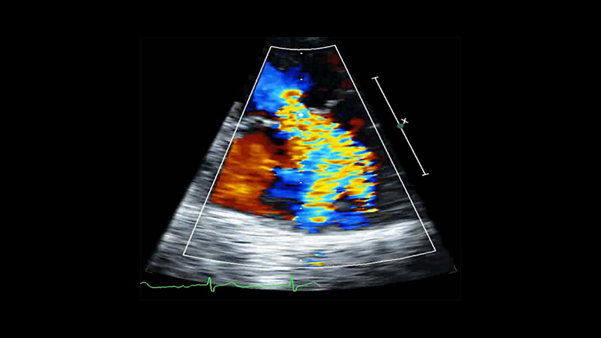 MitraClip Case Study