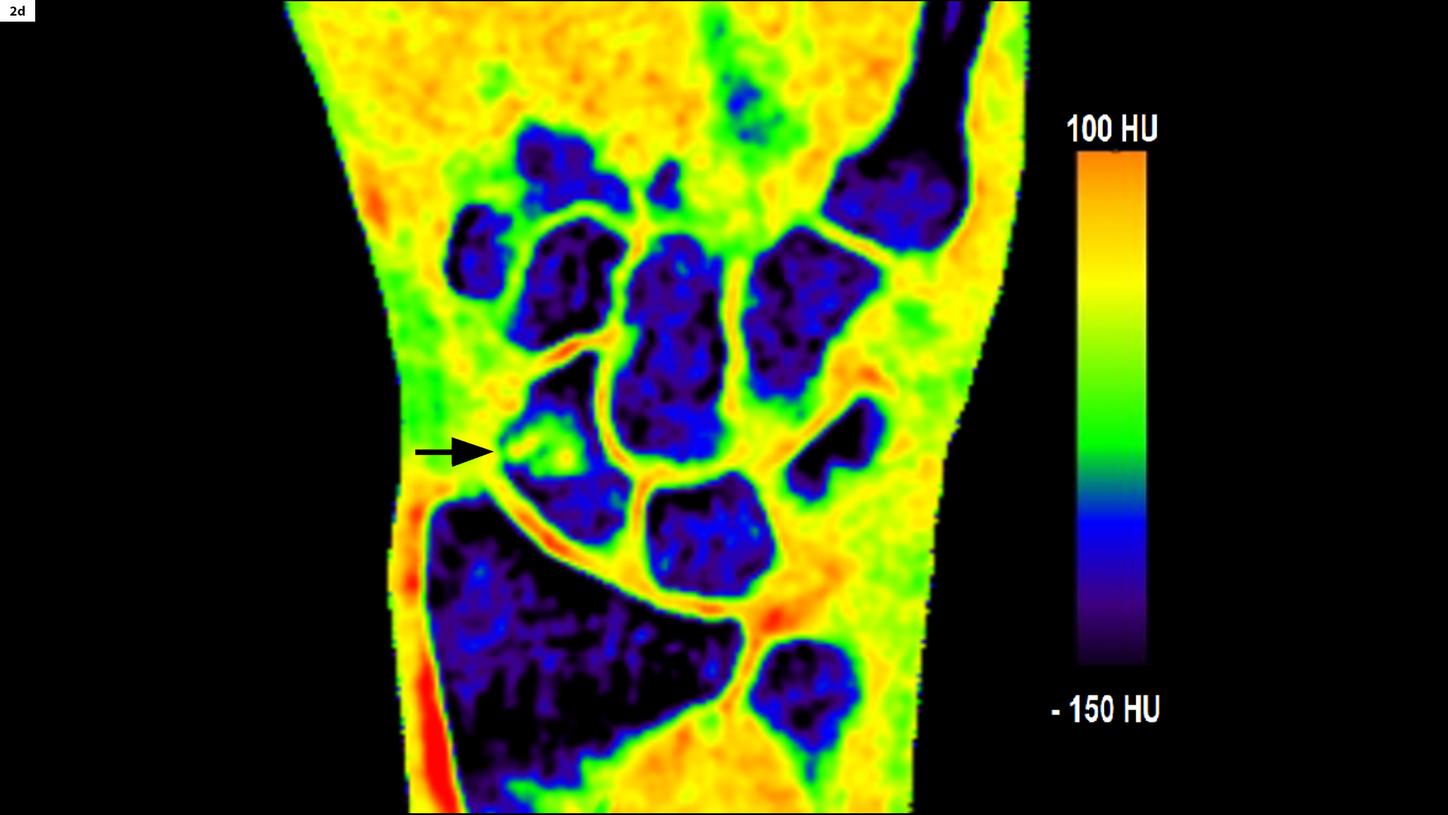 Scaphoid fracture associated bone marrow edema