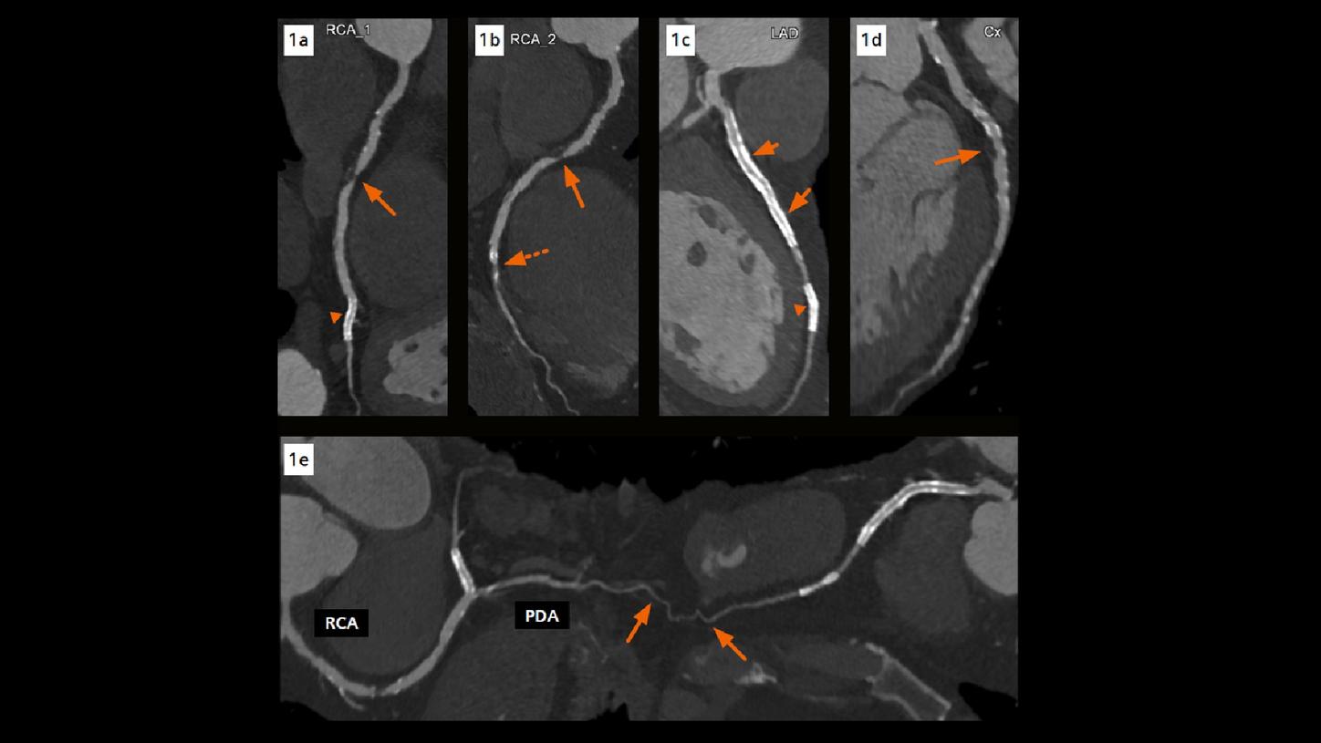 Triple-vessel coronary disease with multiple stents