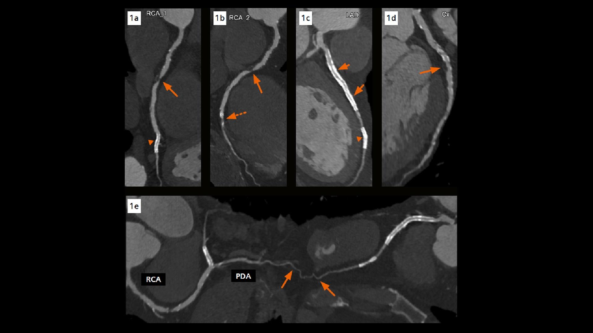 Triple-vessel coronary disease with multiple stents