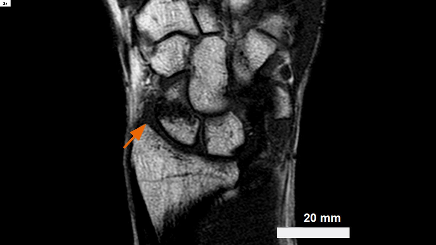 Scaphoid fracture associated bone marrow edema