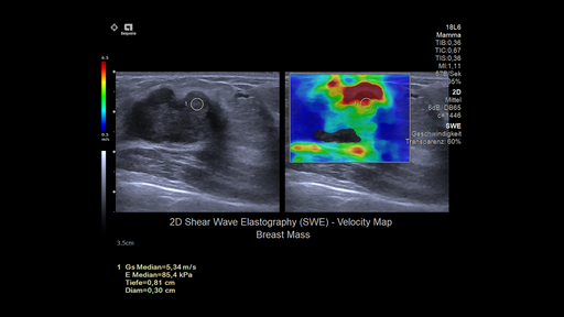 ACUSON Sequoia Ultrasound System