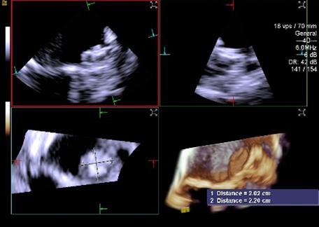 Novel Approach to LAAC Procedure Using 4D ICE