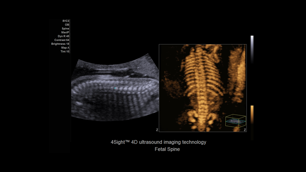 Ультразвуковая система ACUSON Juniper