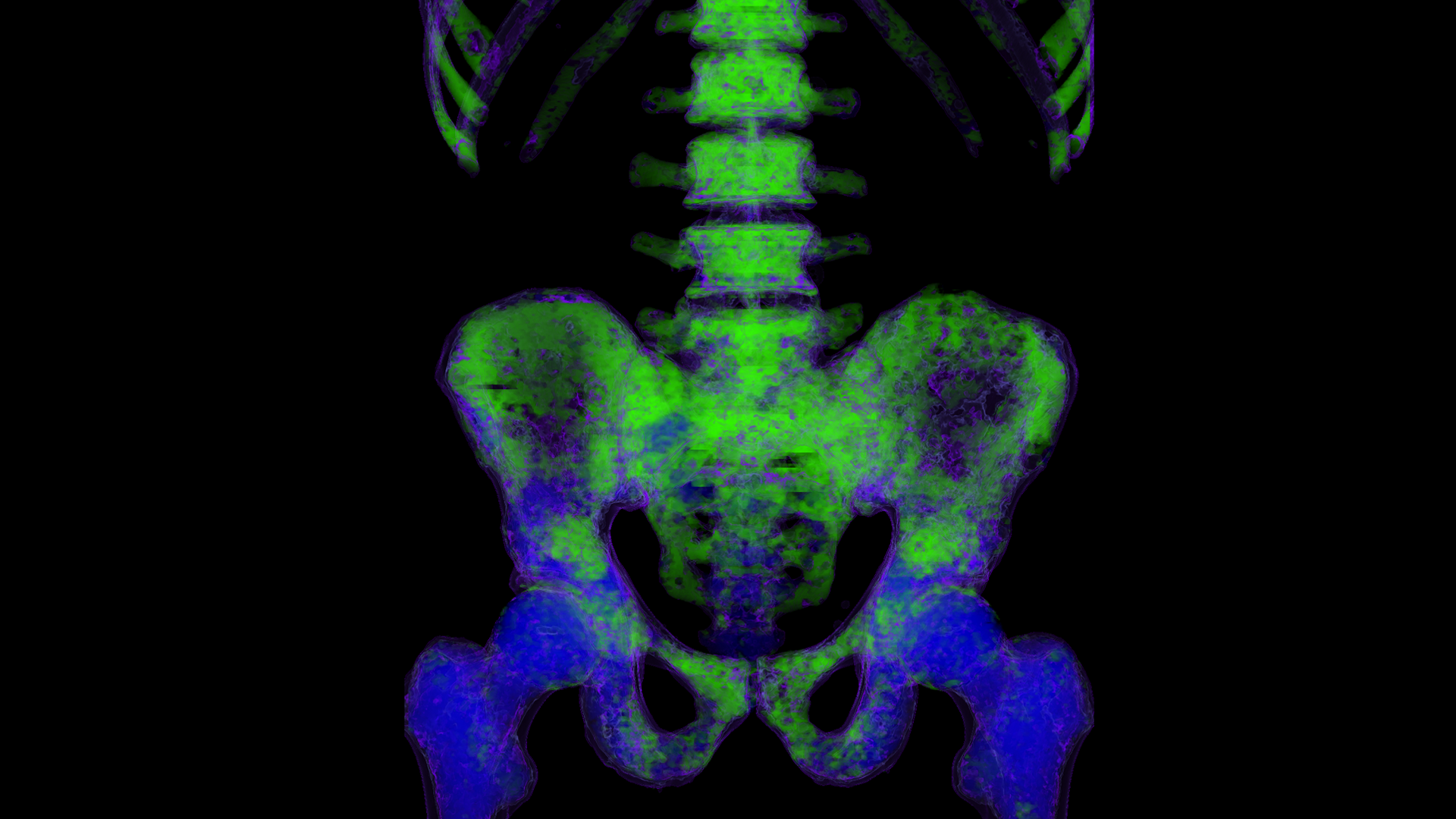 NAEOTOM Alpha photon-counting CT scanner