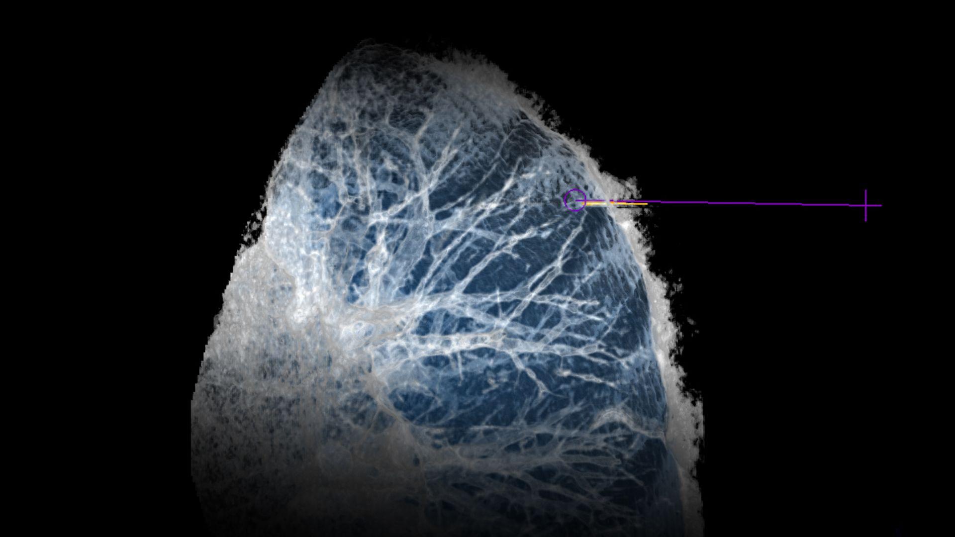 iVATS in the Hybrid OR