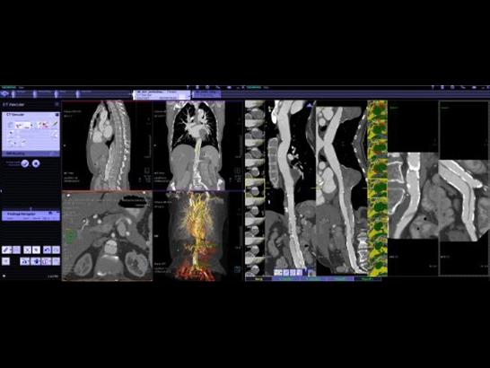 syngo.CT Vascular Analysis