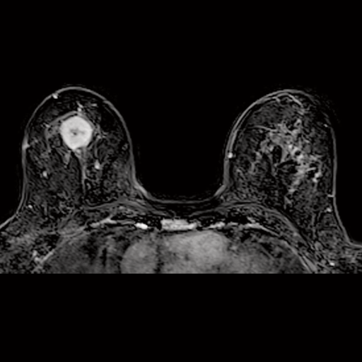 Sentinelle Breast Coil (2/4/8-channel)