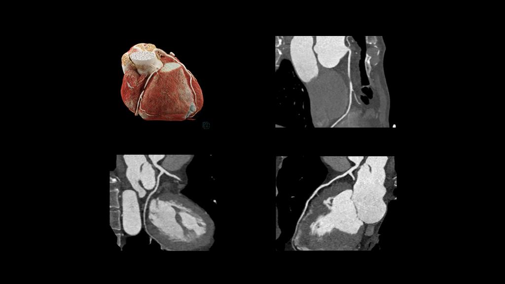 SOMATOM Definition Edge