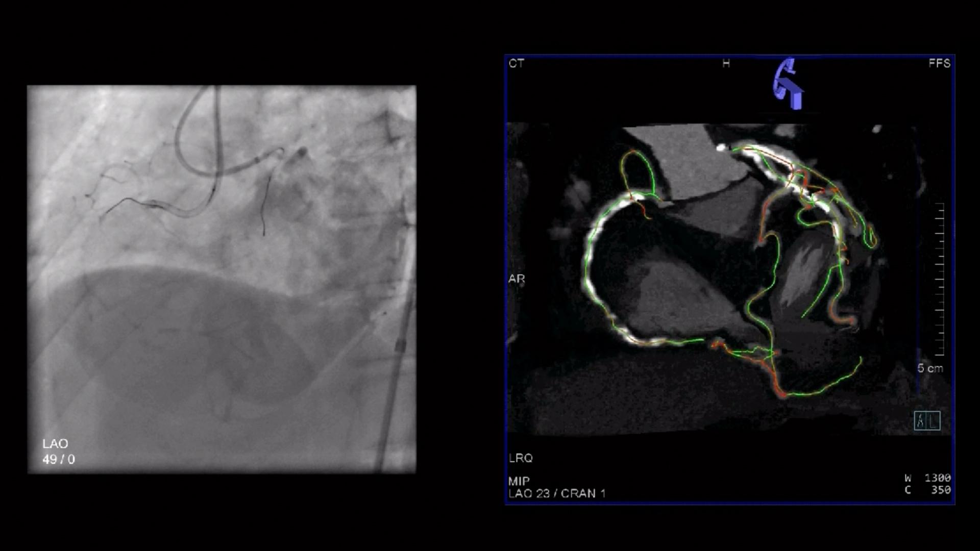 ARTIS icono – Angiography System – Siemens Healthineers