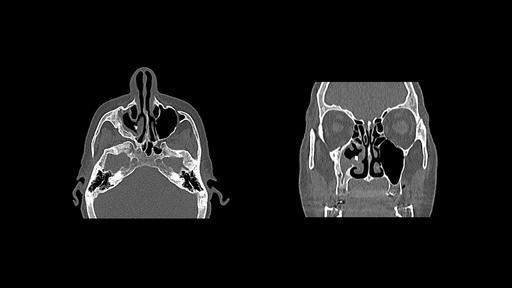 SOMATOM Definition Edge