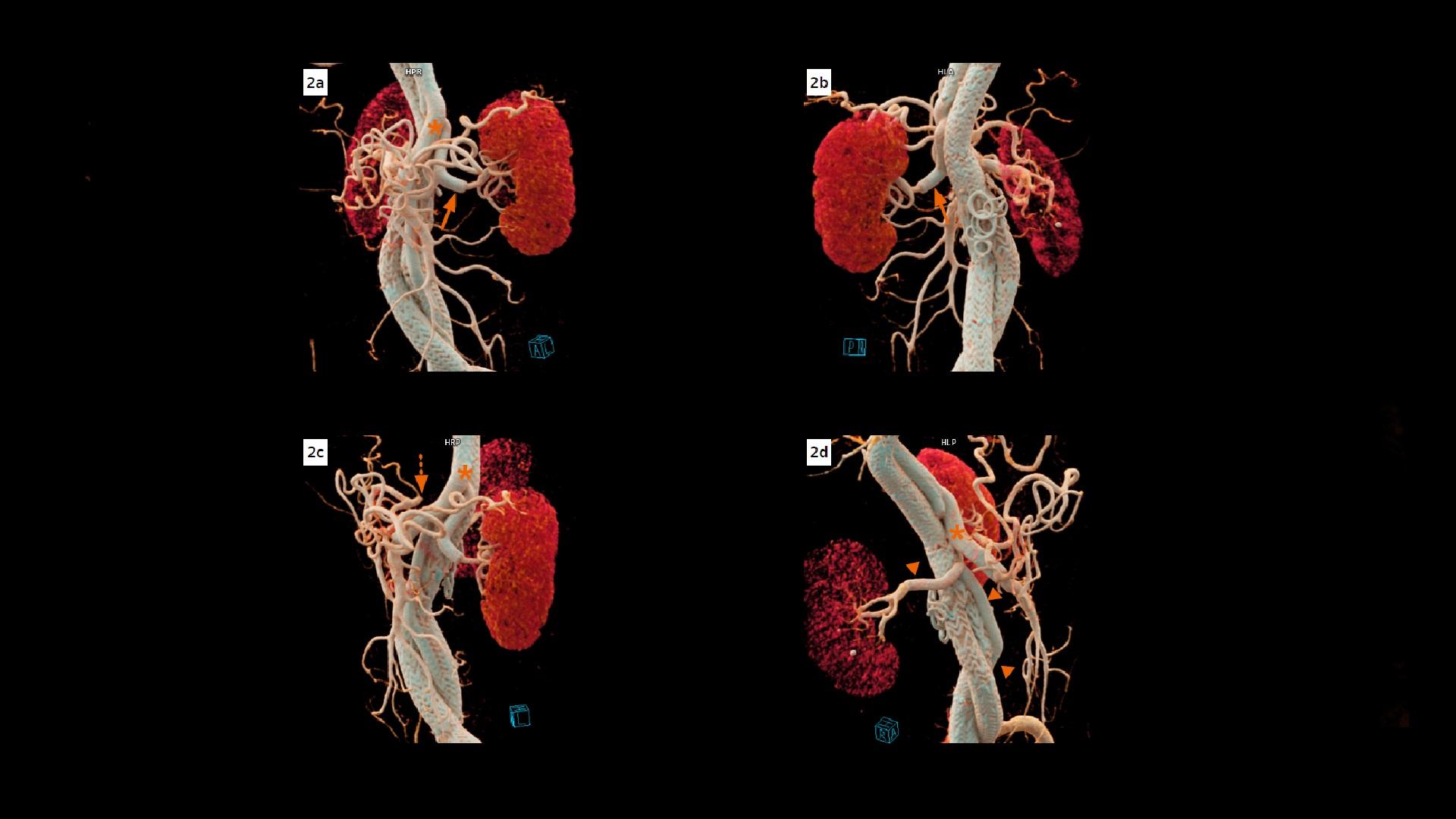 Complex thoracoabdominal aortic aneurysm – EVAR with renovisceral ...