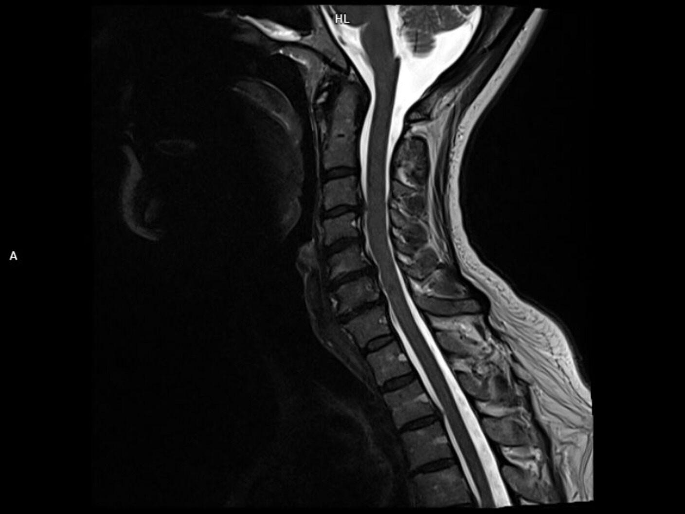 Sagittal T2 TSE-MAGNETOM Lumina