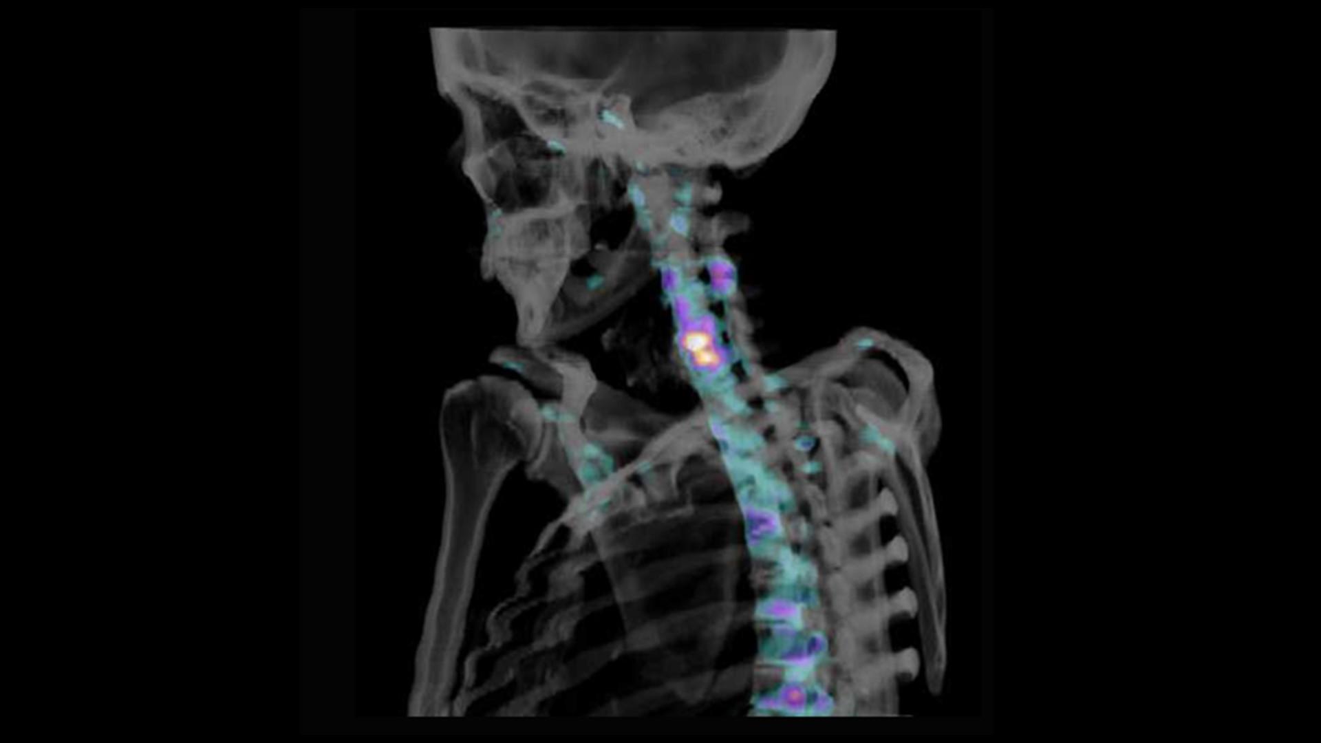 SPECT/CT In Orthopedics